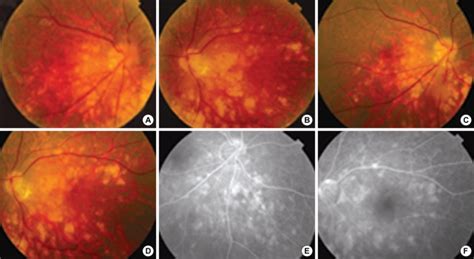 Patient No 21 Fundus Photographs Show Subacute Multifocal Choroiditis Download Scientific
