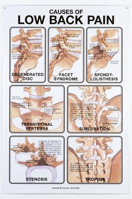 Non Specific Low Back Pain Causes Bing Back Pain Middle Back Pain