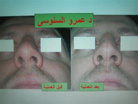 ‫أجزاء الأنف وقياساتها قبل إجراء العملية Facebook‬