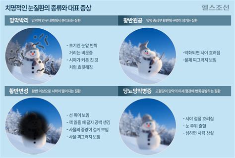 자칫하다간 실명될 수도 치명적인 ‘눈 질환 4가지 당신의 건강가이드 헬스조선
