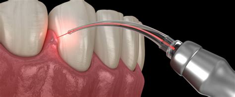 What Is Soft Tissue Laser Dentistry