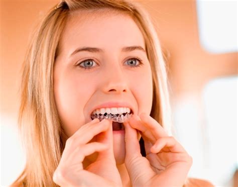 Braces Everett Ceramic And Metal Braces Everett Wa Silver Lake Ortho
