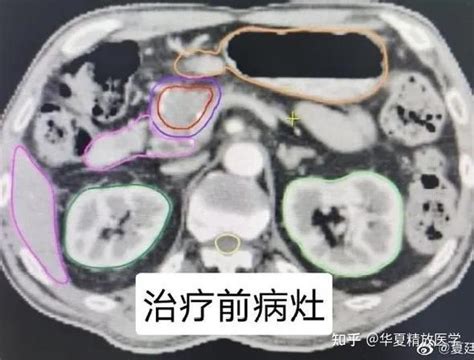 胰腺癌手术、药物治疗之外，精准放疗怎么样？ 知乎