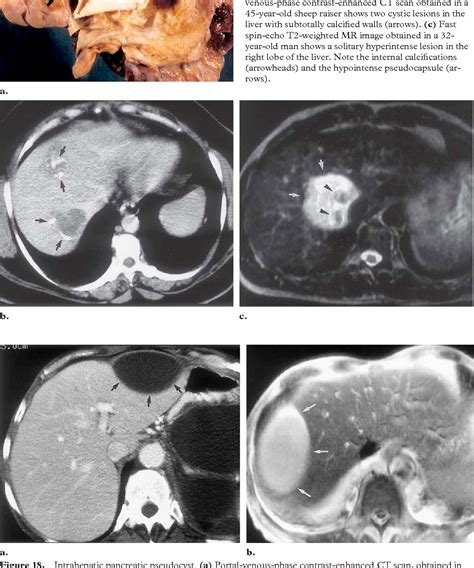 Figure 1 From Cystic Focal Liver Lesions In The Adult Differential Ct