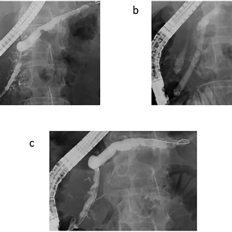 Pdf Placement Of A 6 Mm Fully Covered Metal Stent For Main