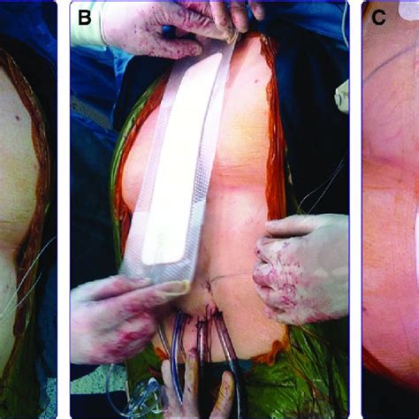 Application Of Pico Single Use Npwt 80 A Immediately Postoperative Download Scientific