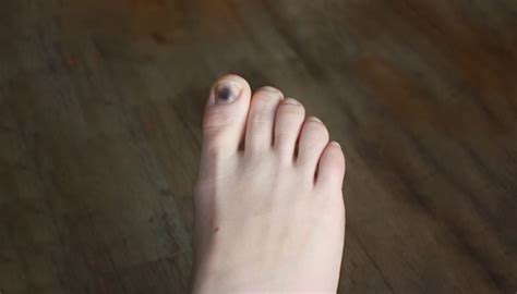 حکم خون مردگی زیر ناخن چیست و مراجع تقلید چه دیدگاهی دارند؟ ستاره