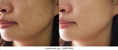 1+ Thousand Before After Skin Whitening Royalty-Free Images, Stock Photos & Pictures | Shutterstock