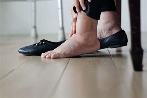 Cankles Definition Causes Management