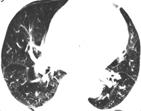 Mosaic Pattern Of Attenuation With Patchy Areas Of Increased And Download Scientific Diagram