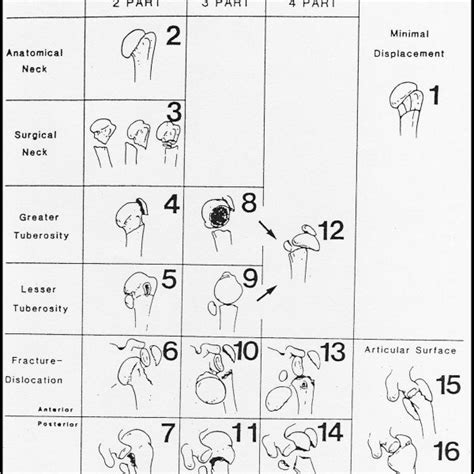 The 16 Categories Of The Neer Classification A Fracture Is Considered