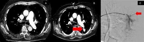 Pulmonary Artery Pseudoaneurysm A Rare Complication After Suction