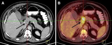 A B 55 Year Old Man With A Perihilar Infiltrative Cholangiocarcinoma Download Scientific