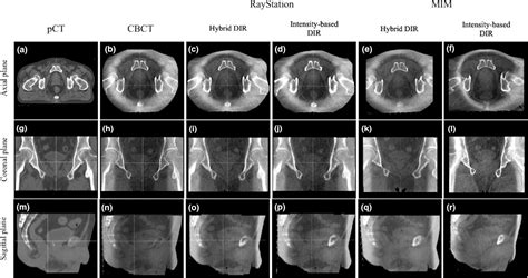 Figure 3 From Usefulness Of Hybrid Deformable Image Registration Algorithms In Prostate