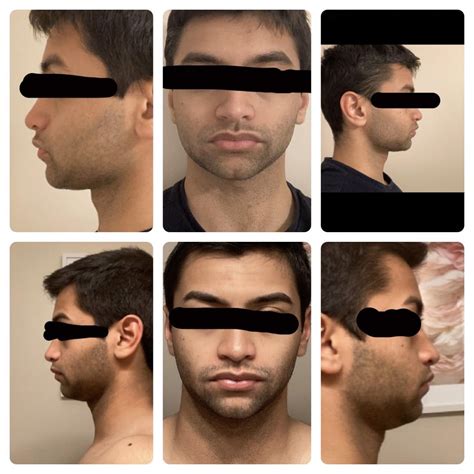 16 Months Mewing Progress R Mewing