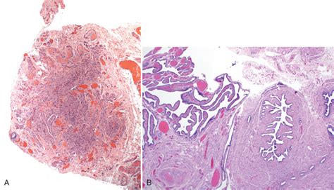 The Fallopian Tube And Broad Ligament Obgyn Key