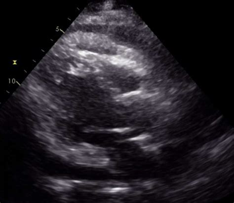 A Rare Case Of Pyogenic Pericarditis Secondary To Streptococcus