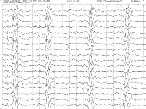Abnormal Eeg Patterns Ppt
