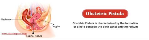 International Day To End Obstetric Fistula 2023