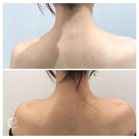 Shoulder Botox Beauty And Personal Care Bath And Body Body Care On Carousell