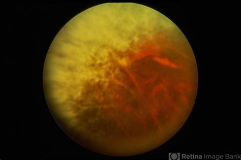 Snowflake Hereditary Degeneration Retina Image Bank