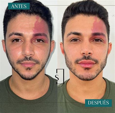 Harmony Face Desde 4 Ml Dra Sierralta