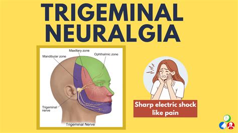 Trigeminal Neuralgia Ent Notes And Lectures