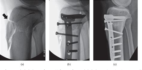 Figure 1 From Open Wedge High Tibial Osteotomy With Distal Tubercle
