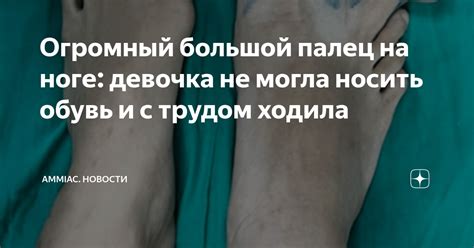 Огромный большой палец на ноге девочка не могла носить обувь и с