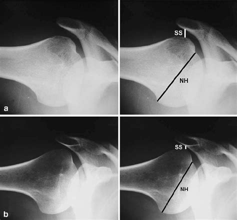 Subacromial Space