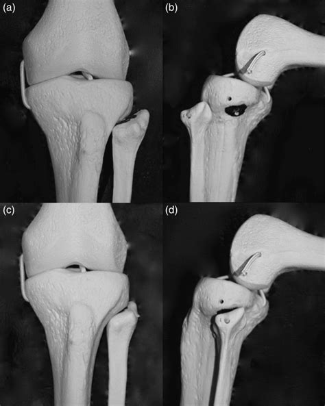 Anatomy In Ptfj Dislocation And In Normal Position Ptfj Dislocation