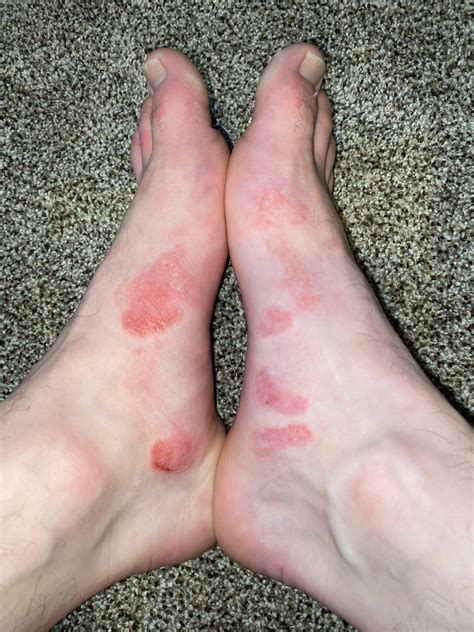 Severe Athletes Foot Rathletesfoot
