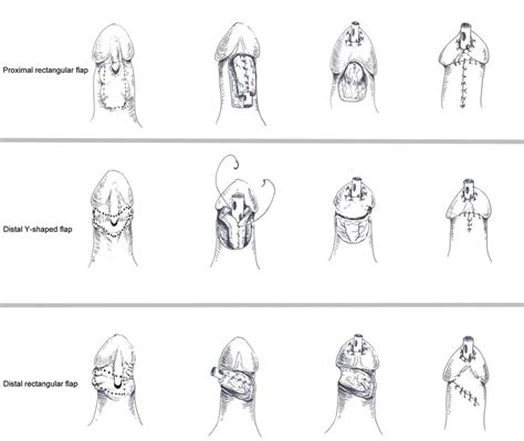 Schematic Diagram Of Mathieu Combined Tunnel Technique Drawn By Cs And