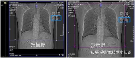 Ct的扫描野和显示野 知乎