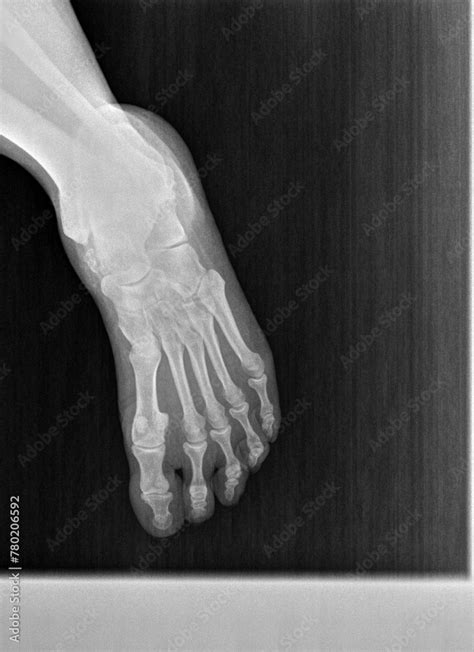 Film Xray Or Radiograph Of A Normal Foot Ankle And Leg Dorsal