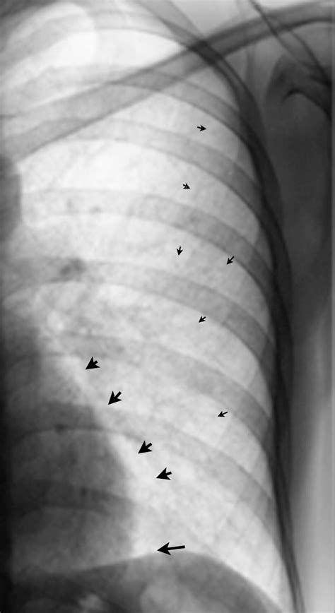 Why Does A Man Have Bilateral Nodular Densities On Chest Radiograph