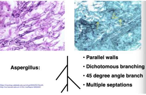 Pneumocystis Aspergillus Mucormycosis • Lecture 5 • 4 9 Flashcards