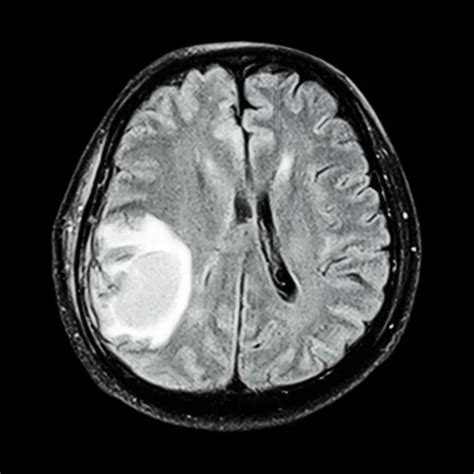 Mri Brain Show Brain Tumor At Right Parietal Lobe Of Cerebrum Stock