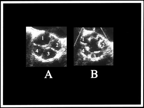Aortic Valve Cusps Echo