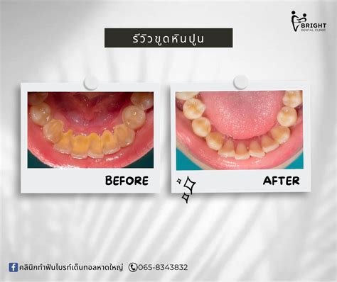 🍍 รู้จักสังเกตภายในช่องปากตัวเอง 🦷 ไม่ควรปล่อยให้หินปูนขึ้น เพราะเป็น