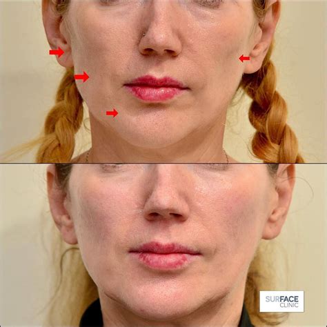 Cheek Fillers Bradford Restore Midface Volume And Cheek Lift