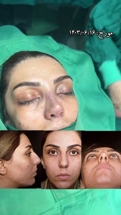 توضیحات دکتر منوچهر فاضلی در مورد جراحی بینی گوشتی بهترینجراحبینی