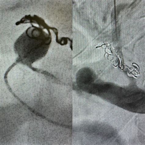 Obsidio Patientcare Embolization Interventionalradiology Peter
