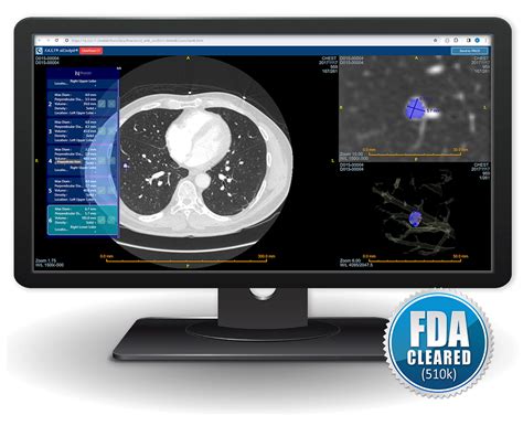 Ct Lung Nodule Ai Software Application