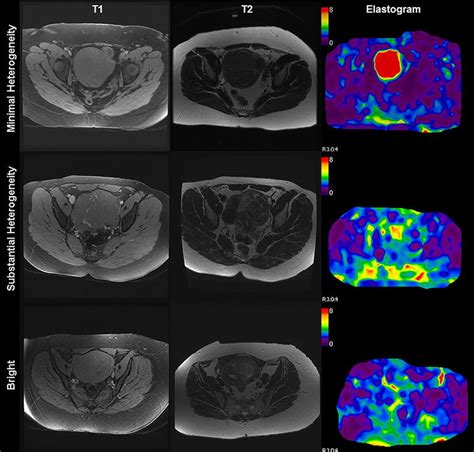 Fibroid Appearance On Mri And Corresponding Mr Elastogram Magnetic