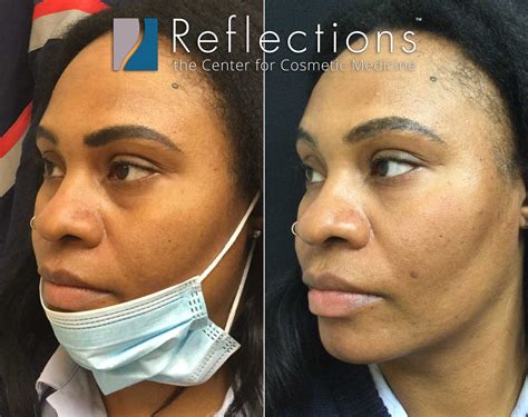 Under Eye Filler With Cheek Support Pre Treatment With Filler Before And After Photos New Jersey