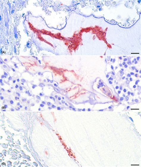 Immunohistochemical Demonstration Of Intraosseous Aggregates Of