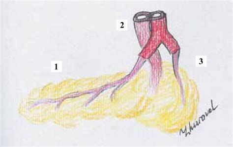 Graft Revascularization Via 3 Main Arteries 1 Splenic Artery 2