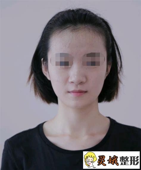 蒜头鼻缩小整形图片小翘鼻子整形图片第9页大山谷图库