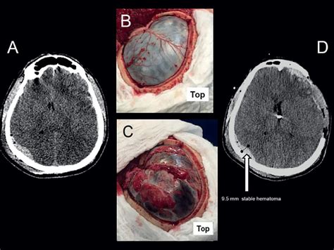 What Is Epidural Hematoma Teroes